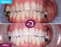 Teeth Whitening Milton Keynes | Milton Keynes Teeth Whitening