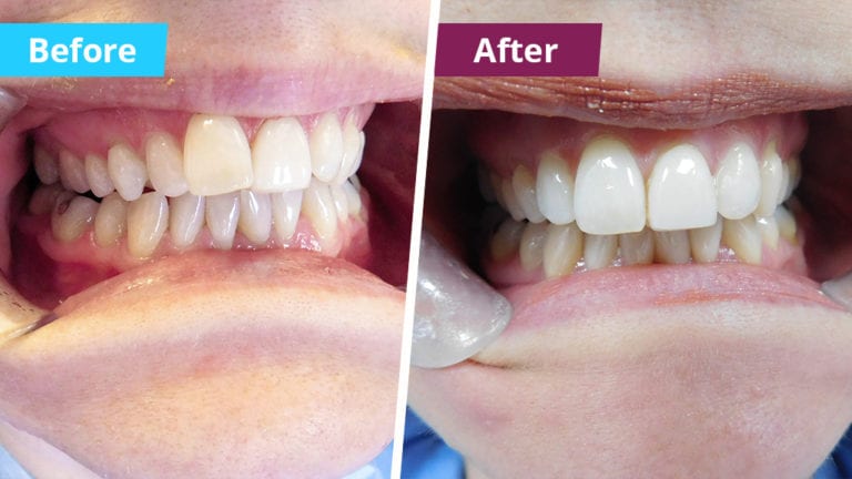 invisalign lite - Aspects Dental & Referral - Milton Keynes