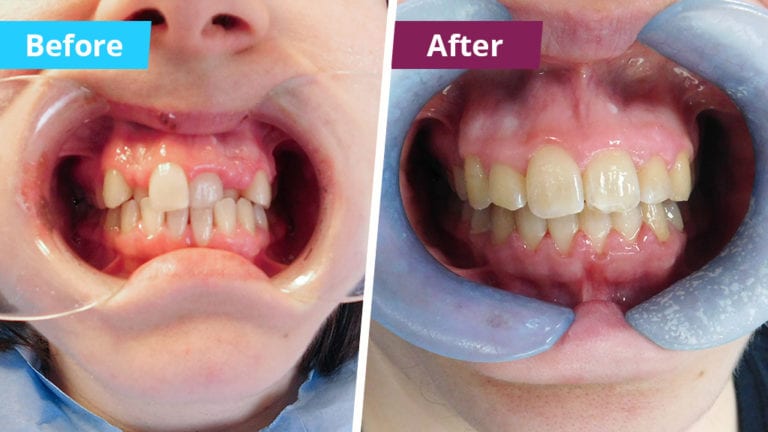 upper and lower ceramic braces - Aspects Dental & Referral - Milton Keynes