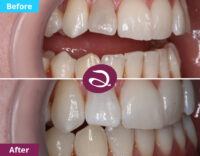 Teeth Whitening Milton Keynes | Milton Keynes Teeth Whitening