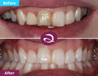 Teeth Whitening Milton Keynes | Milton Keynes Teeth Whitening