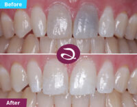 Teeth Whitening Milton Keynes | Milton Keynes Teeth Whitening