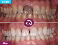 Teeth Whitening Milton Keynes | Milton Keynes Teeth Whitening