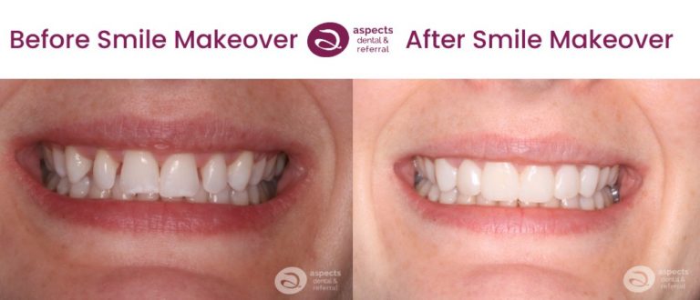 Milton Keynes Dentist Completes Smile Makeover Using Fixed Dental ...