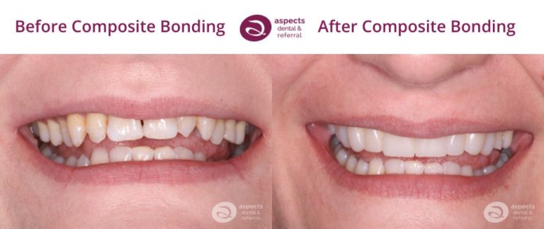 Composite Bonding Teeth Before And After Archives - Aspects Dental ...