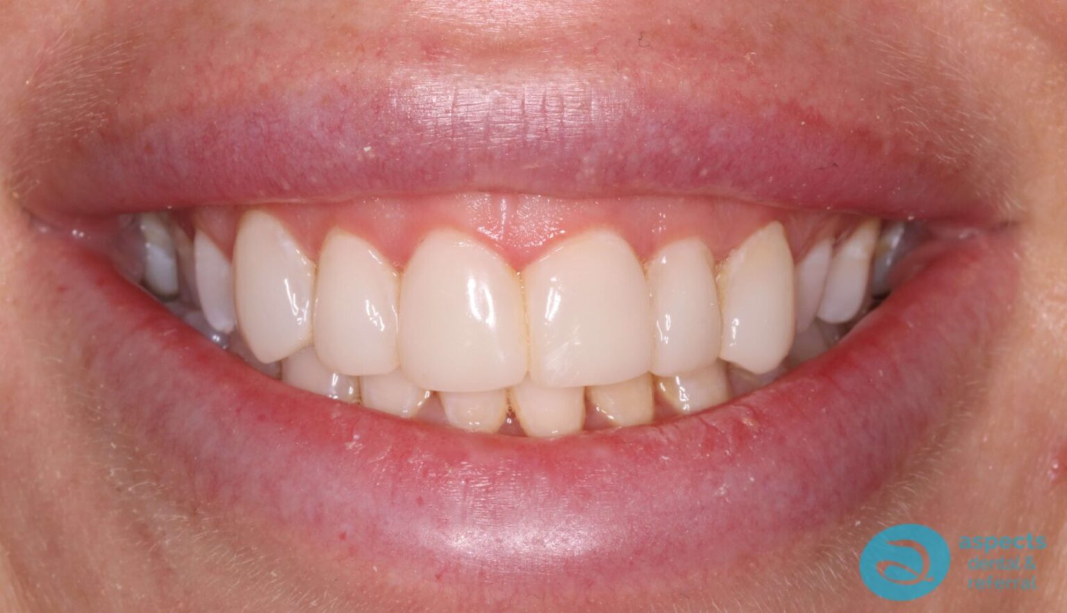 Dental Veneers Before And After Case Study 18 & Photos