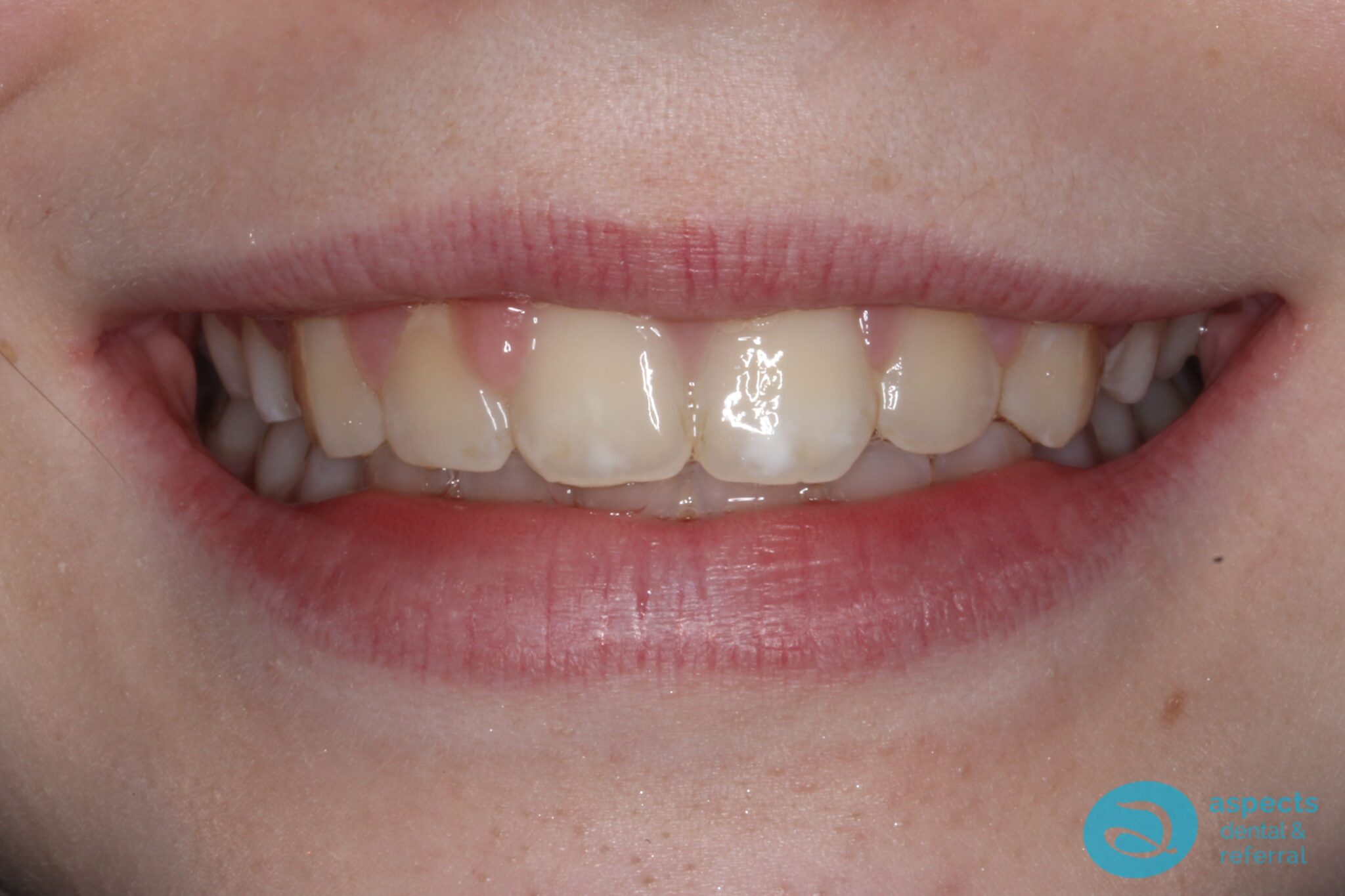 Case 3 D.Z - Aspects Dental & Referral - Milton Keynes