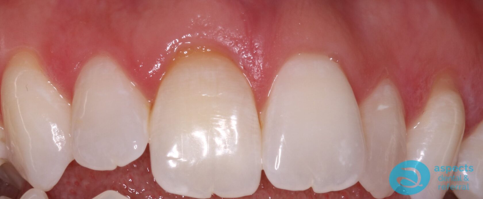 Teeth Whitening Milton Keynes | Milton Keynes Teeth Whitening